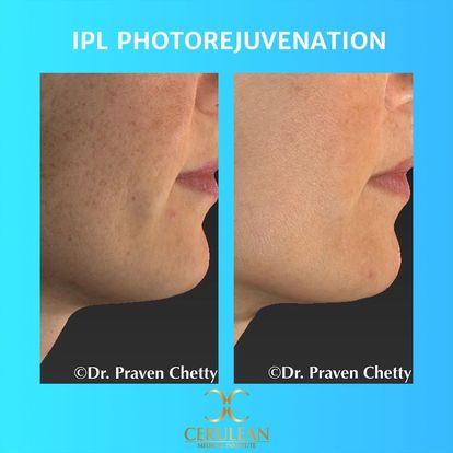 IPL Photorejuvenation Kelowna, IPL Kelowna Specialists