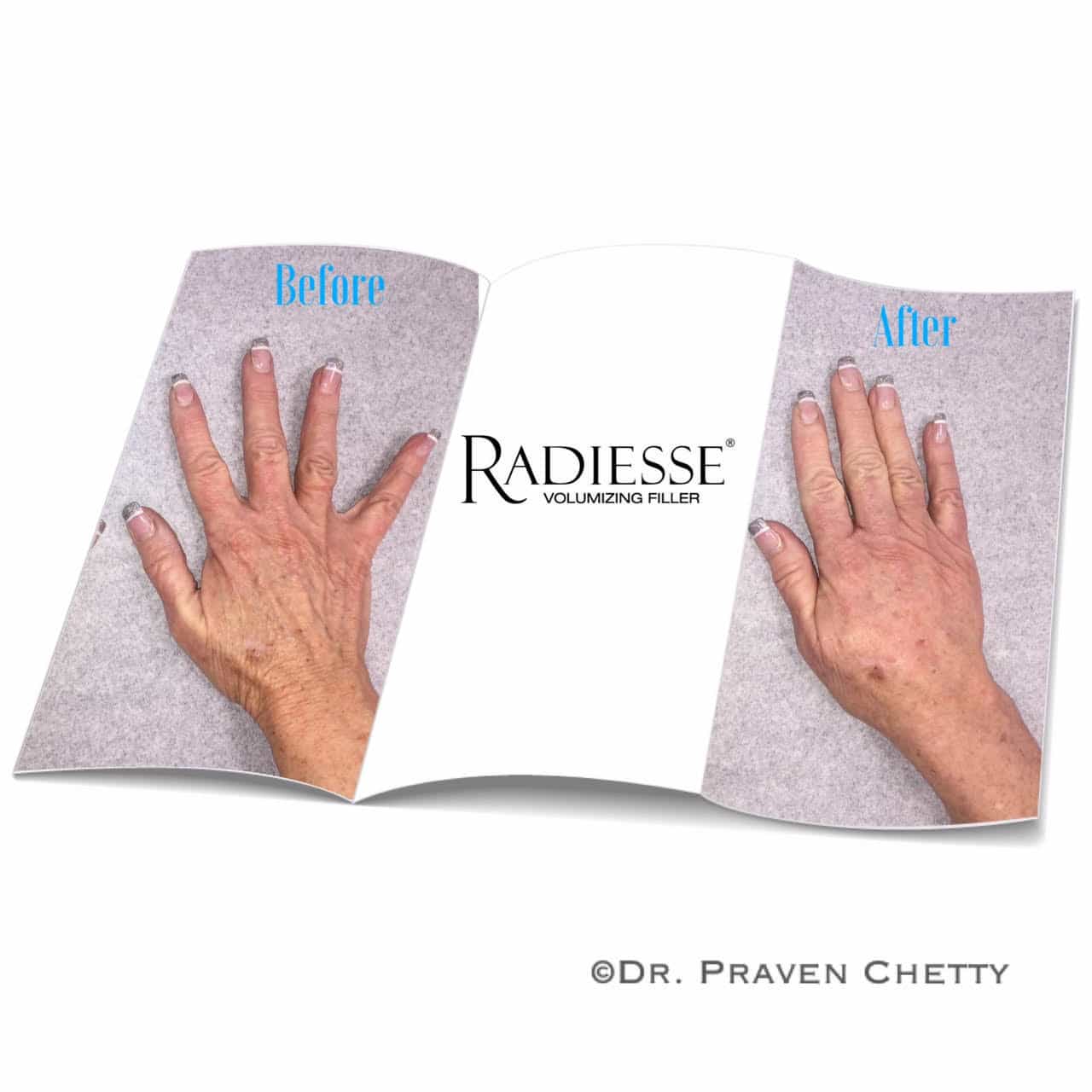 Hand Rejuvenation with Radiesse in Kelowna | Cerulean Medical Institute