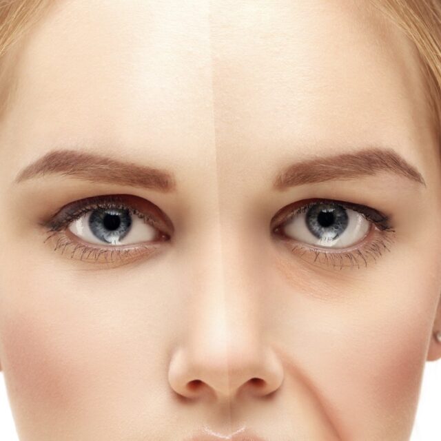 The Art & Anatomy of Beautification: Treating Aging in The Mid-Face