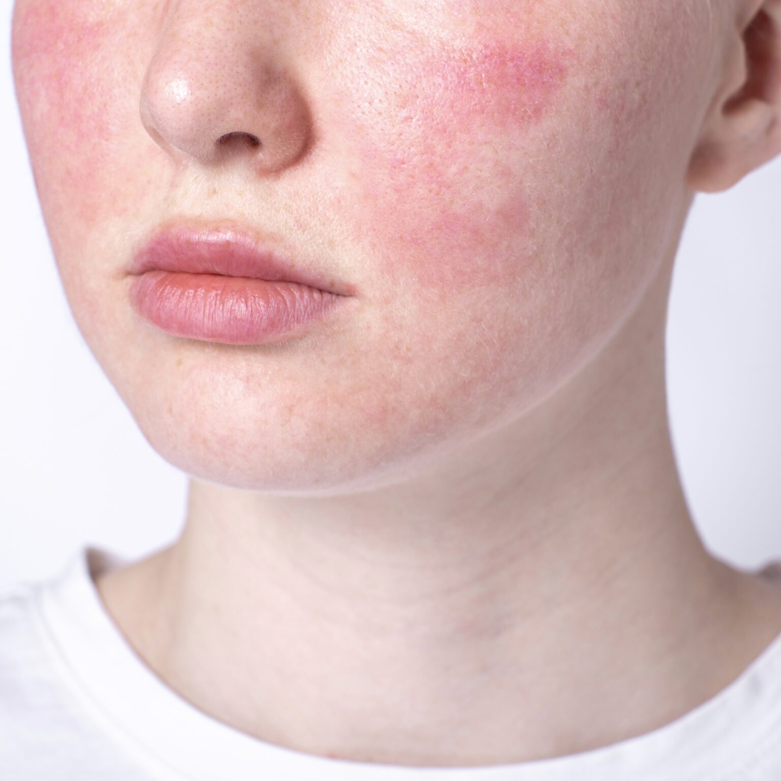 Rosacea Laser Treatment Benefits | Cerulean Medical Institute - Kelowna BC